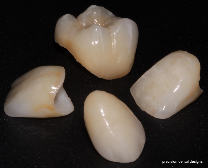 Precision Dental Designs - Anchorage AK Dental Lab